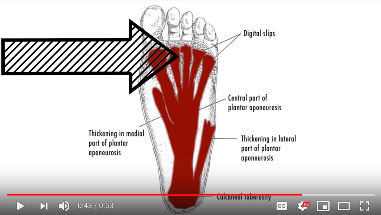 Plantar Fasciitis Part 1 What Is It And How Do I Know If Have It